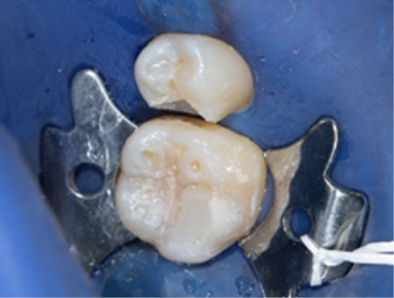 Restauración de clase II en un segundo premolar mandibular