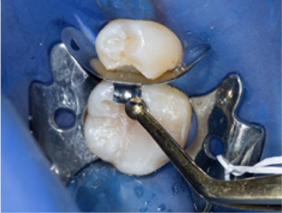Restauración de clase II en un segundo premolar mandibular
