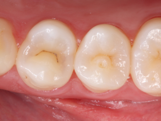 Guía Clínica: Restauración Clase II del Primer Premolar con Caries ...