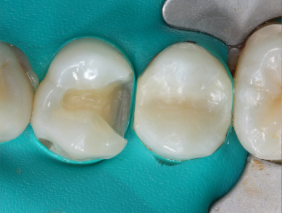 Guía Clínica: Restauración Clase II del Primer Premolar con Caries ...