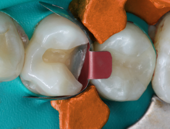 Guía Clínica: Restauración Clase II del Primer Premolar con Caries ...