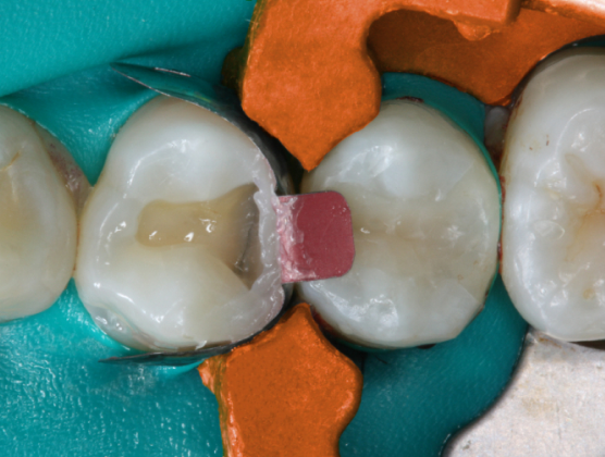 Guía Clínica: Restauración Clase II del Primer Premolar con Caries ...