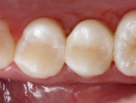 Guía Clínica: Restauración Clase II del Primer Premolar con Caries ...